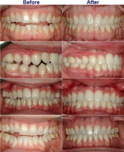 Myofunctional Therapy - Innovative Therapy 4-Kids, Inc.